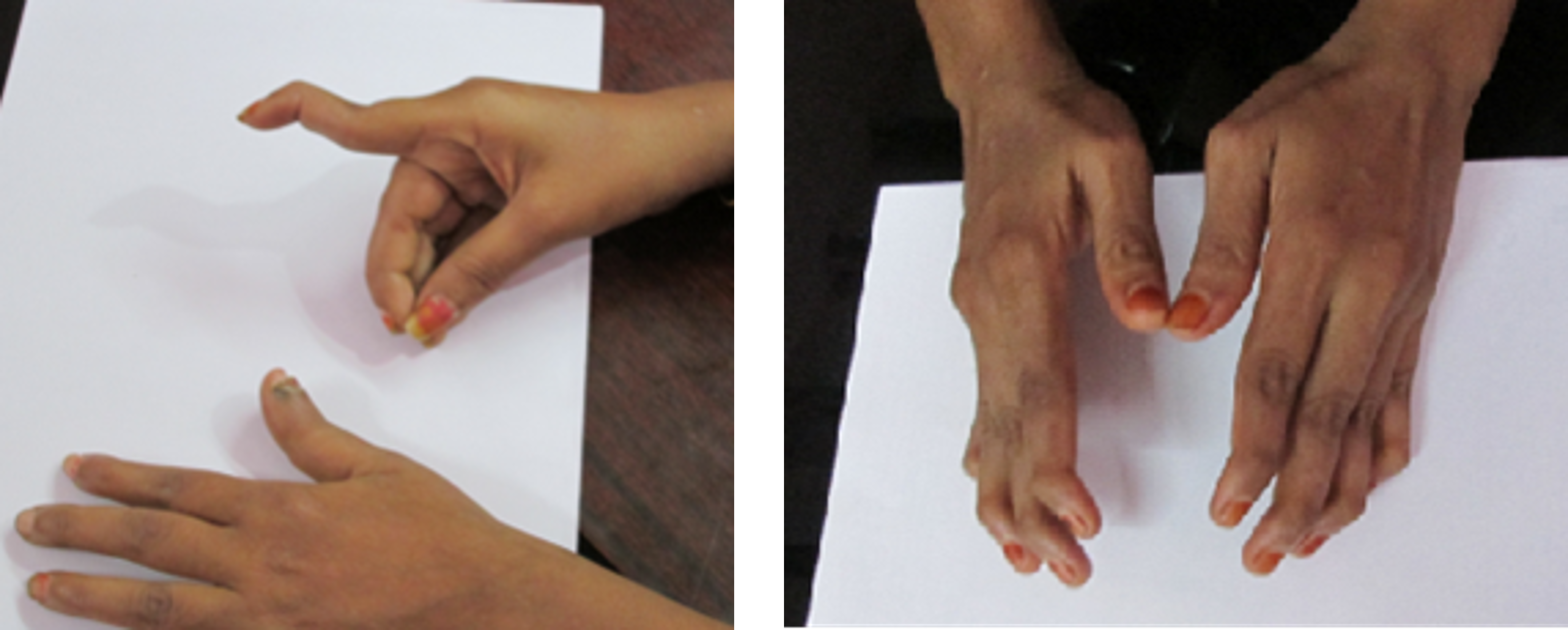 Swan neck deformity – Rheuma Tv